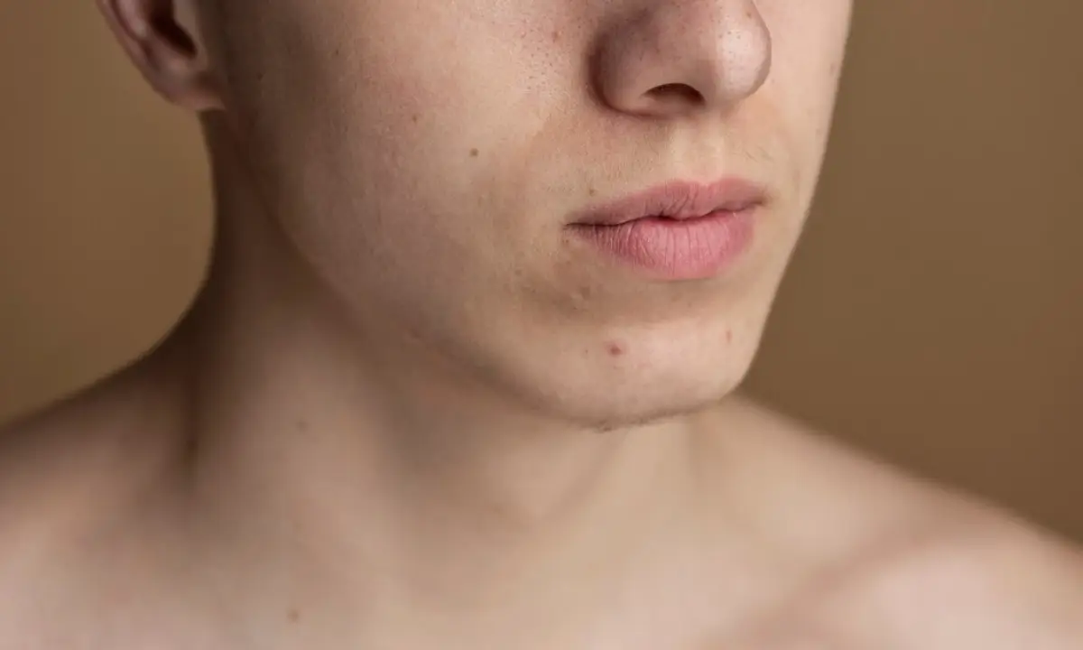 7 How to Remove Facial Scars for Clear and Scar-Free Skin