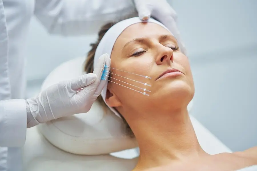 5 Benefits of Facial Thread Lifting
