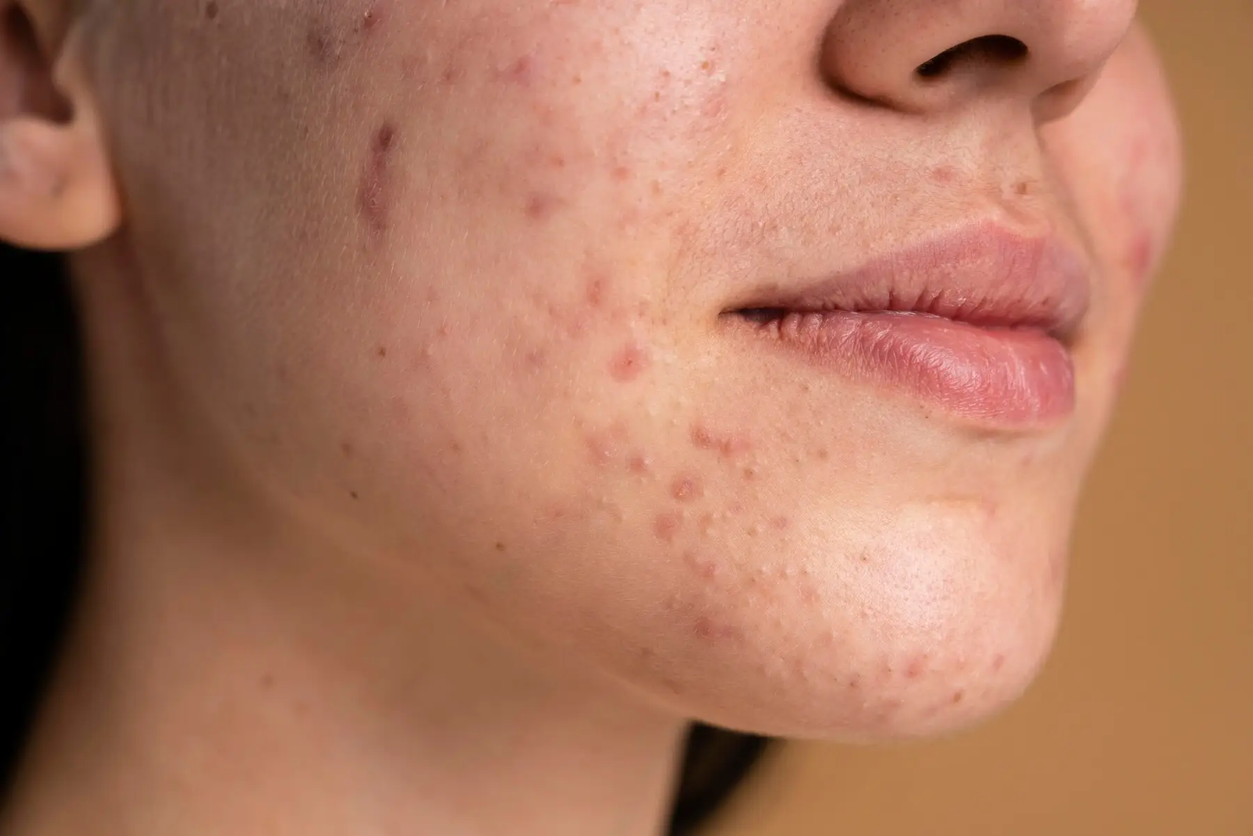 7 Causes of Cheek Acne Appearing in the Same Spot