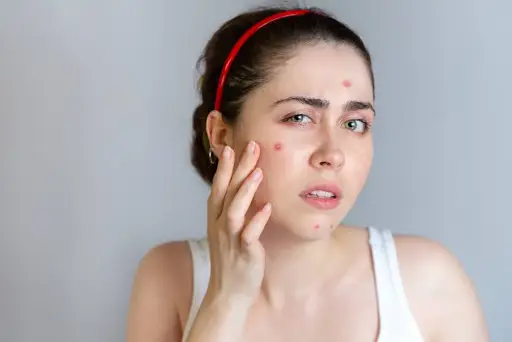 Why Do Pimples Appear After a Chemical Peel? Find Out Here!
