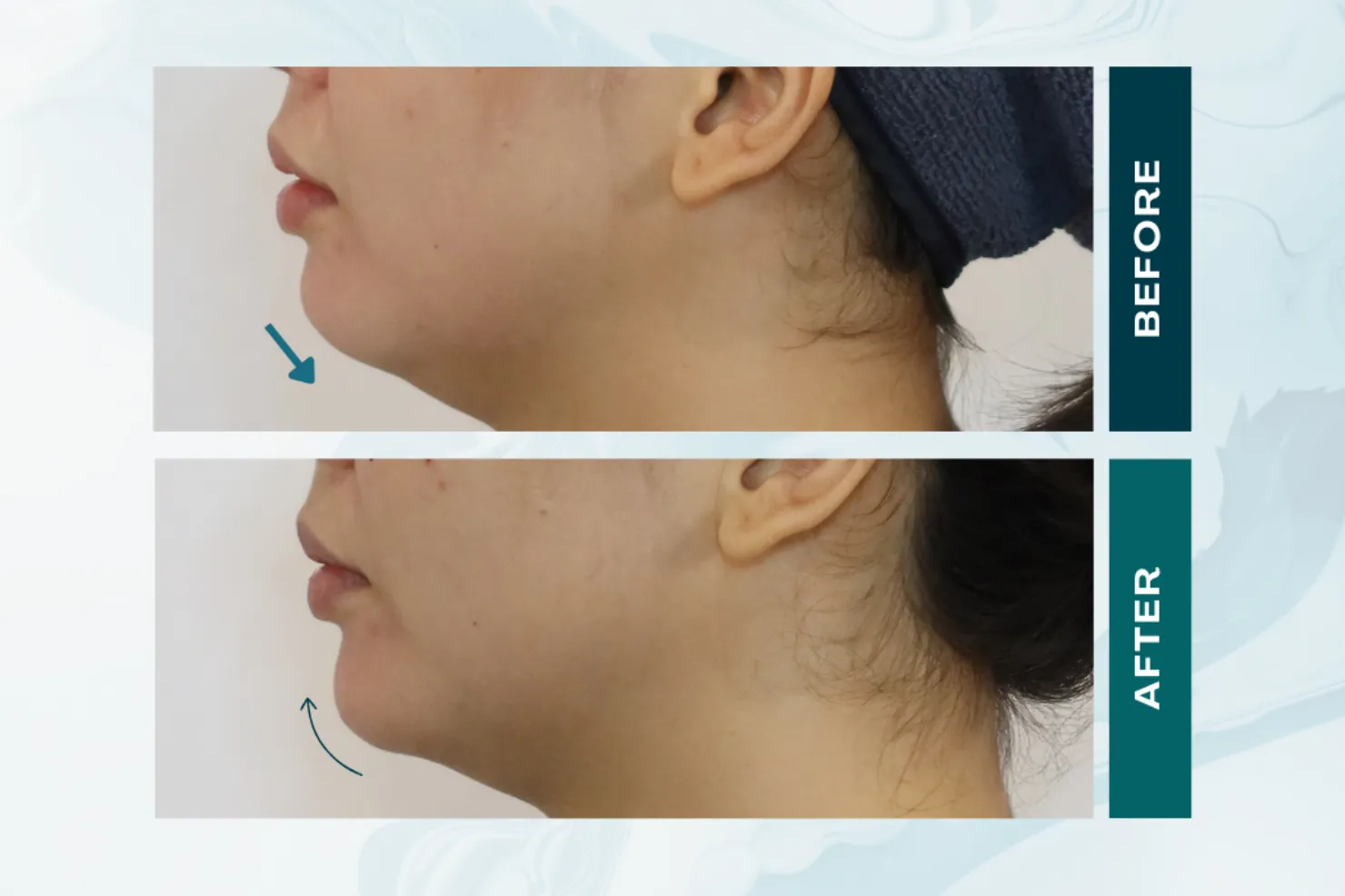 Real Chin Filler Before and After Results